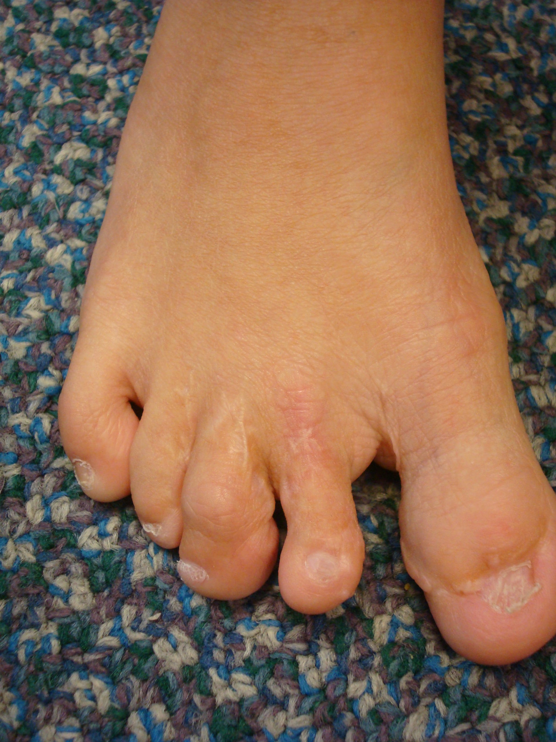 Nail Abnormalities - Ectodermal Dysplasias Symptoms | NFED