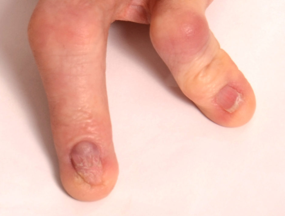 Nail Abnormalities - Ectodermal Dysplasias Symptoms | NFED