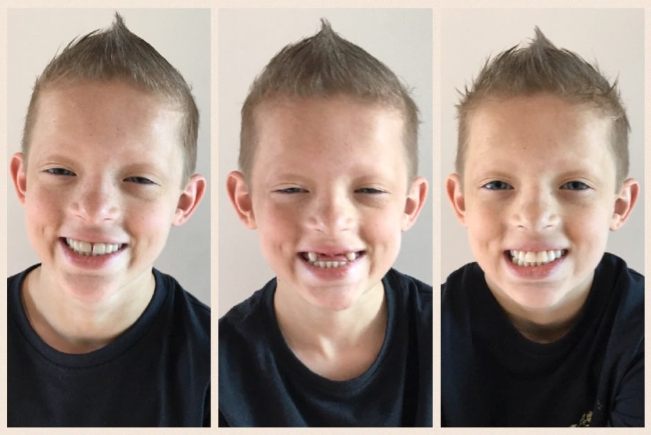 Dentures for Kids - NFED