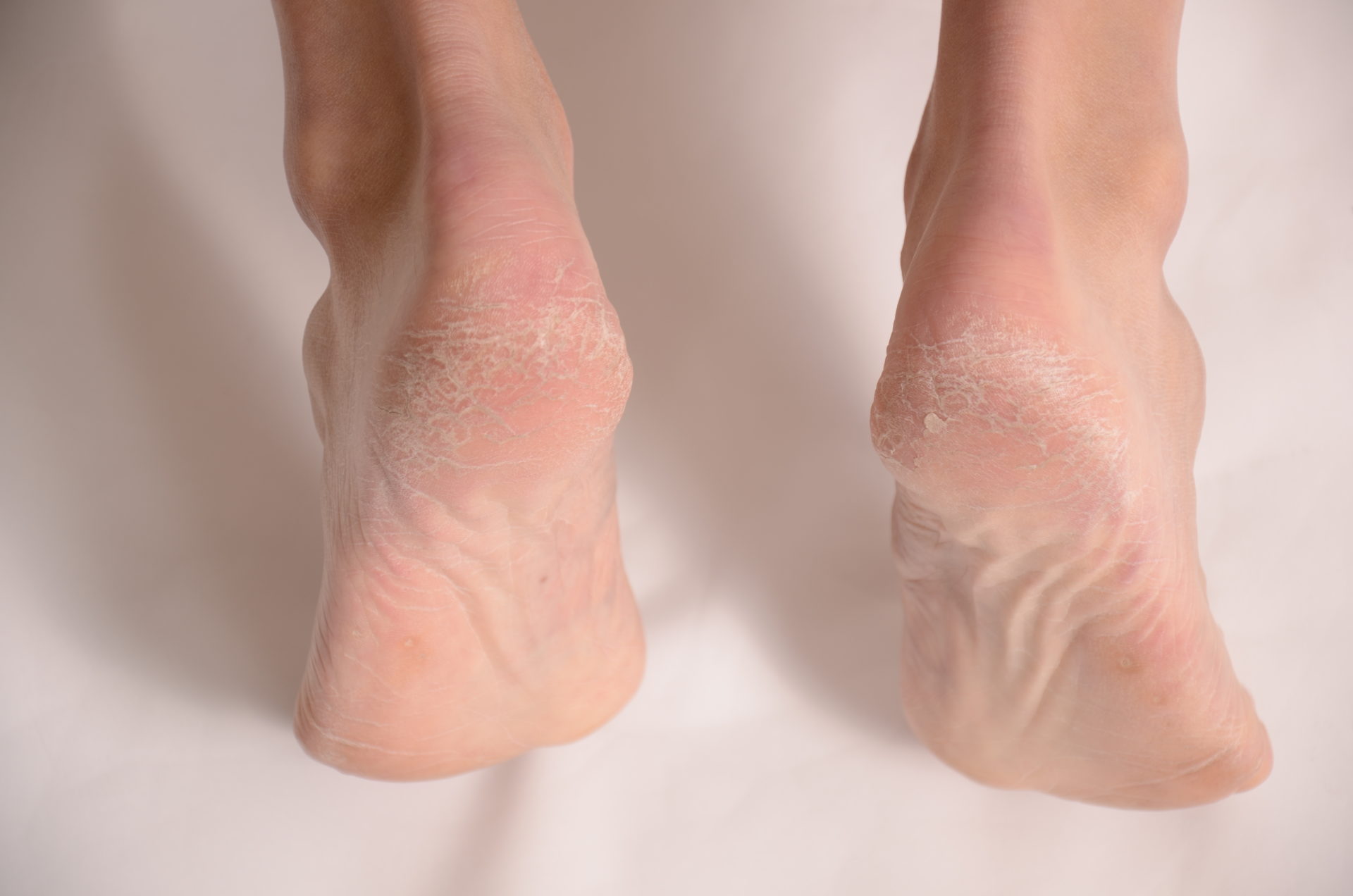 Ectodermal Dysplasias Skin Symptoms | NFED