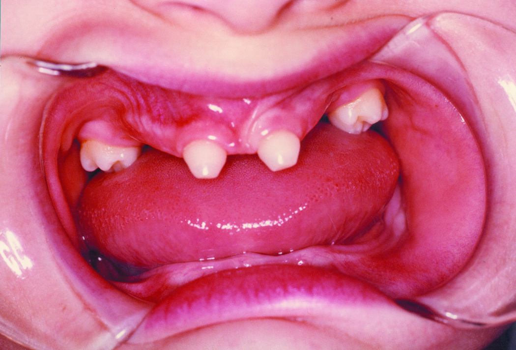 Dental Symptoms - Ectodermal Dysplasia | NFED