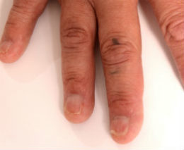 Nail Abnormalities - Ectodermal Dysplasias Symptoms | NFED
