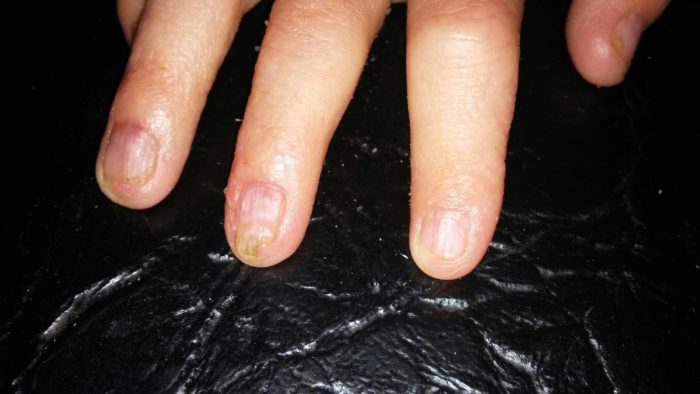 Nail Abnormalities - Ectodermal Dysplasias Symptoms | NFED