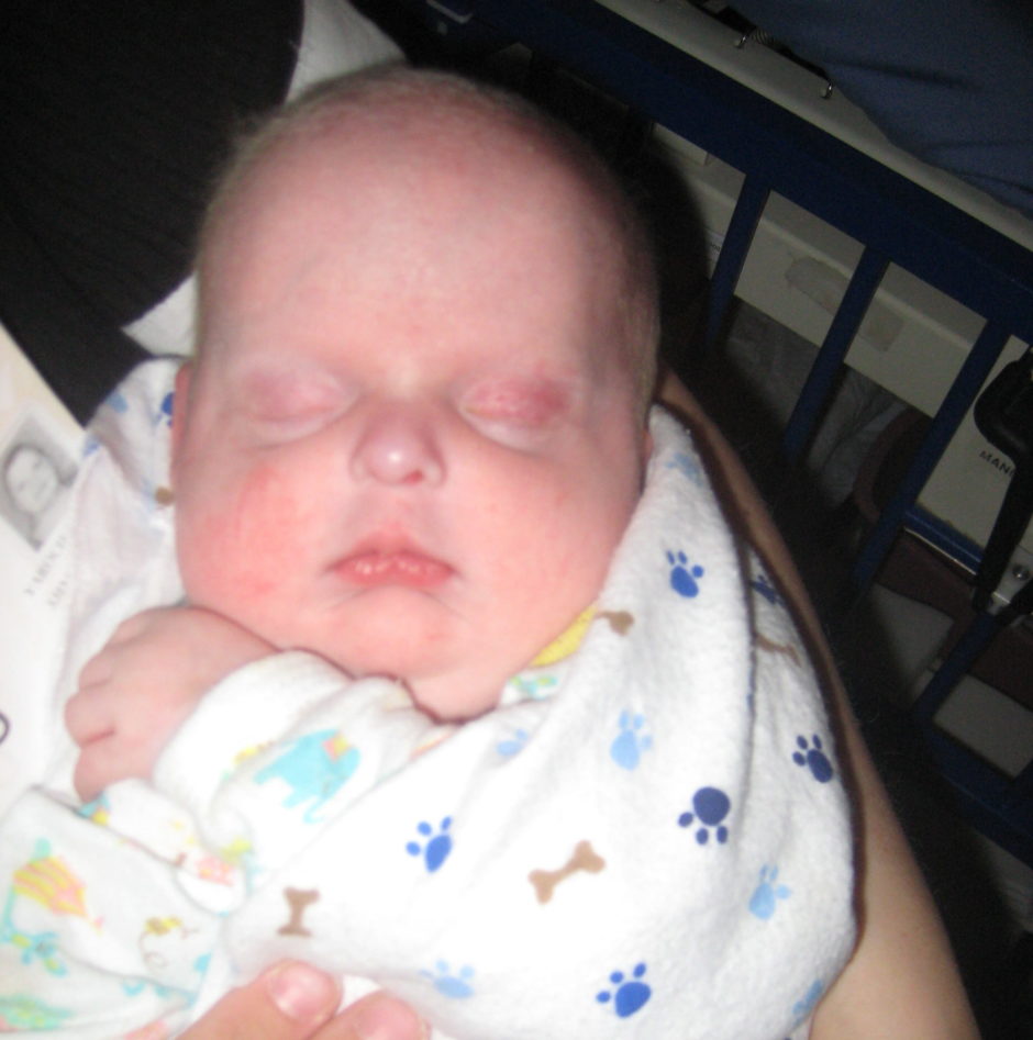 Ectodermal Dysplasias Skin Symptoms | NFED