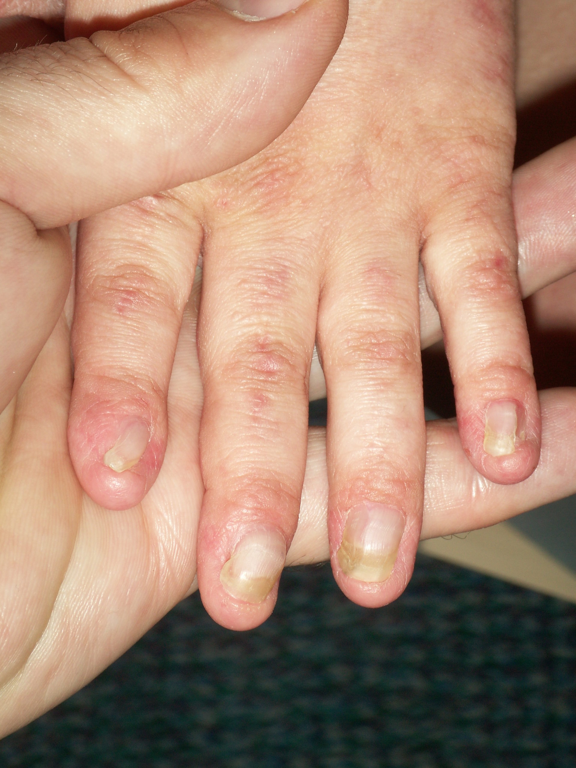 Nail Abnormalities - Ectodermal Dysplasias Symptoms | NFED