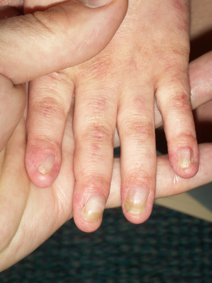 Nail Abnormalities - Ectodermal Dysplasias Symptoms | NFED