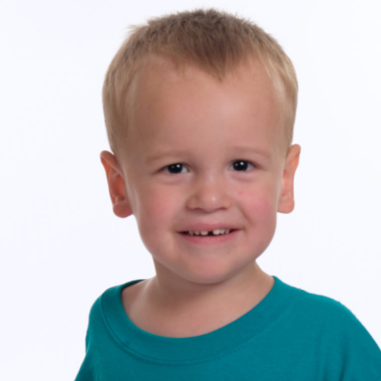 WNT10A Gene Causes Three Types of Ectodermal Dysplasia - NFED