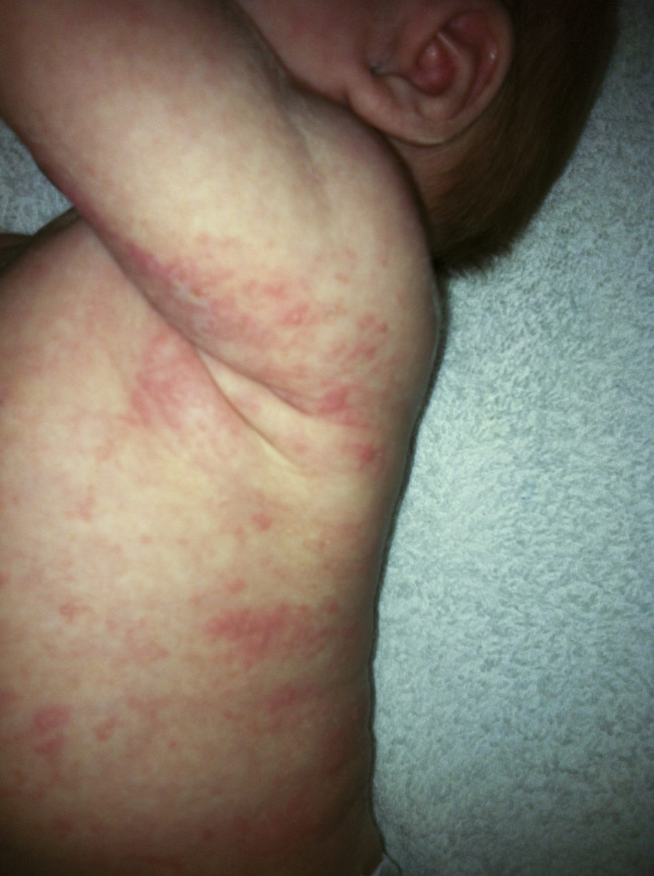 What You Need To Know To Help Your Child's Vision If They Have IP - NFED