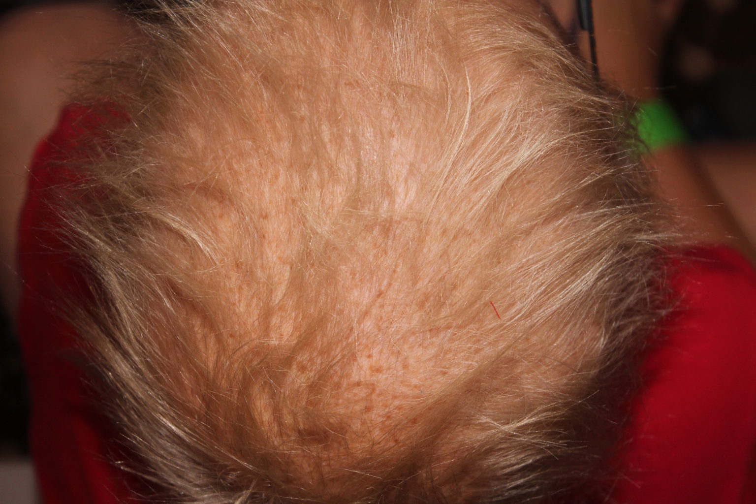 Check Out These Budget Friendly Webinars About Ectodermal Dysplasias - NFED