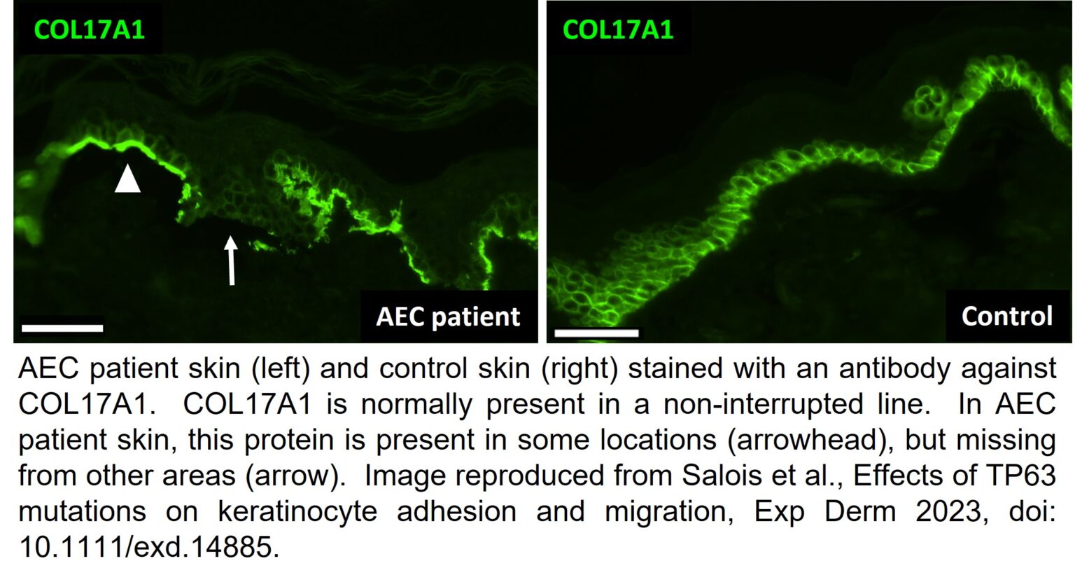 Missing Proteins May Contribute to Skin Fragility in AEC Syndrome - NFED