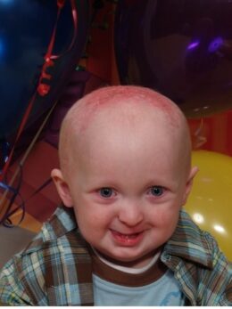 Fragile to Thriving: The First 15 Years of Living with AEC Syndrome