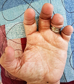 No Fingerprints Can Be An Ectodermal Dysplasia Thing - NFED
