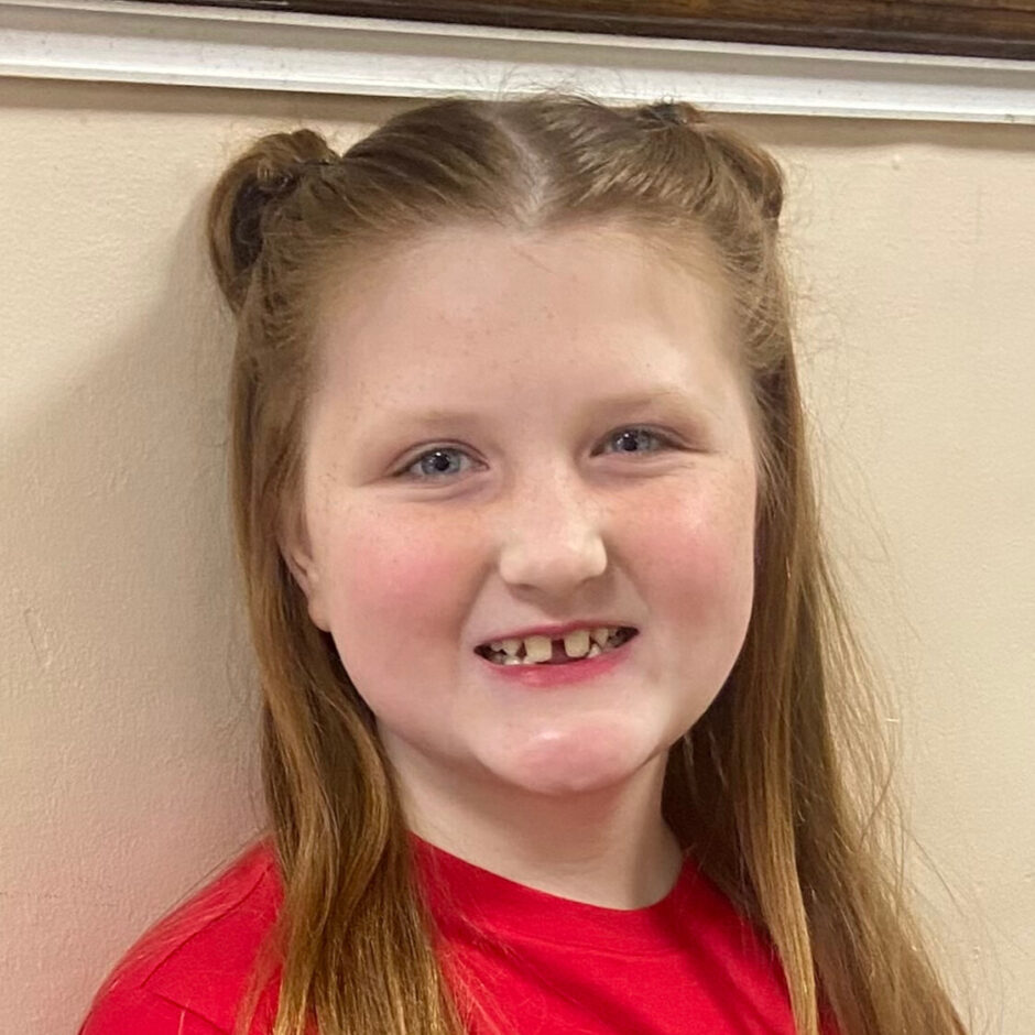 Tspear Related Ectodermal Dysplasia Nfed